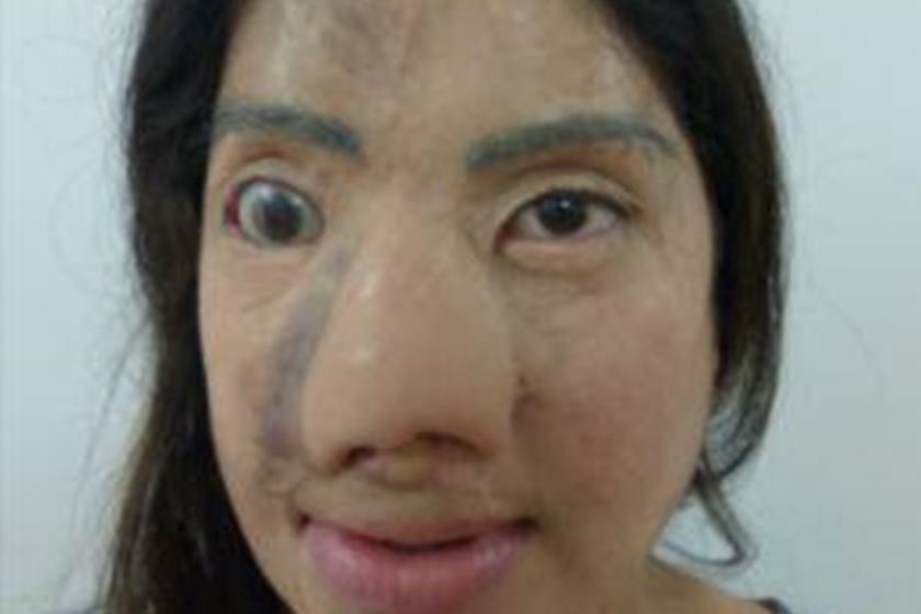 Mulher Fica Desfigurada Após Amiga Ciumenta Jogar ácido No Rosto Dela