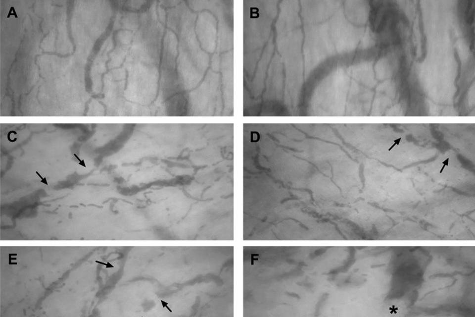 Brasileiros comprovam que Covid-19 causa microtrombose em pacientes ...