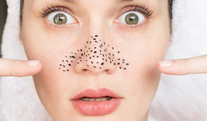 Cravos no rosto: dermatologista ensina como dar adeus ao problema ...