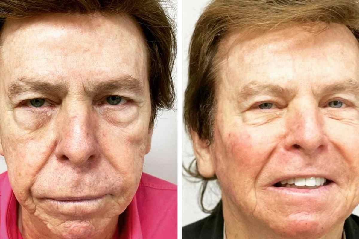 Nelson Rubens fala sobre harmonização facial e rebate: “Não tenho 83 ...