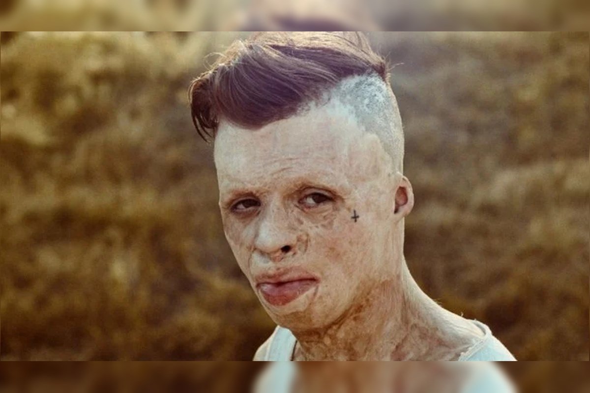 Jovem que teve 90% do corpo queimado: “Mais medo da vida que da morte ...