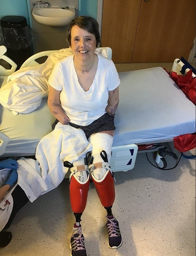 Mulher com pernas e braços amputados após infecção reaprende a andar ...