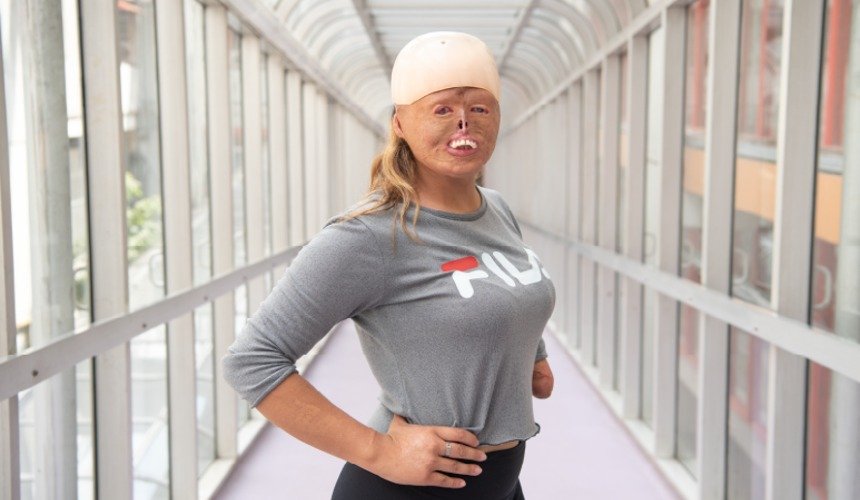 jovem que teve 88% do corpo queimado se torna inspiração - Blog Cursos ...