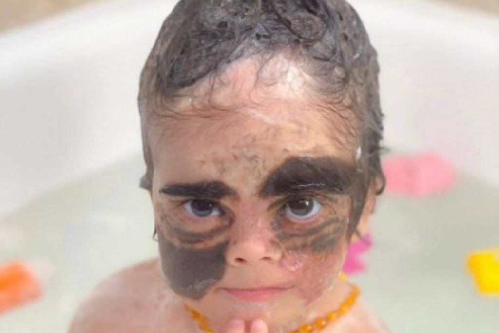 Menina que nasceu com “máscara do Batman” já passou por 5 cirurgias ...