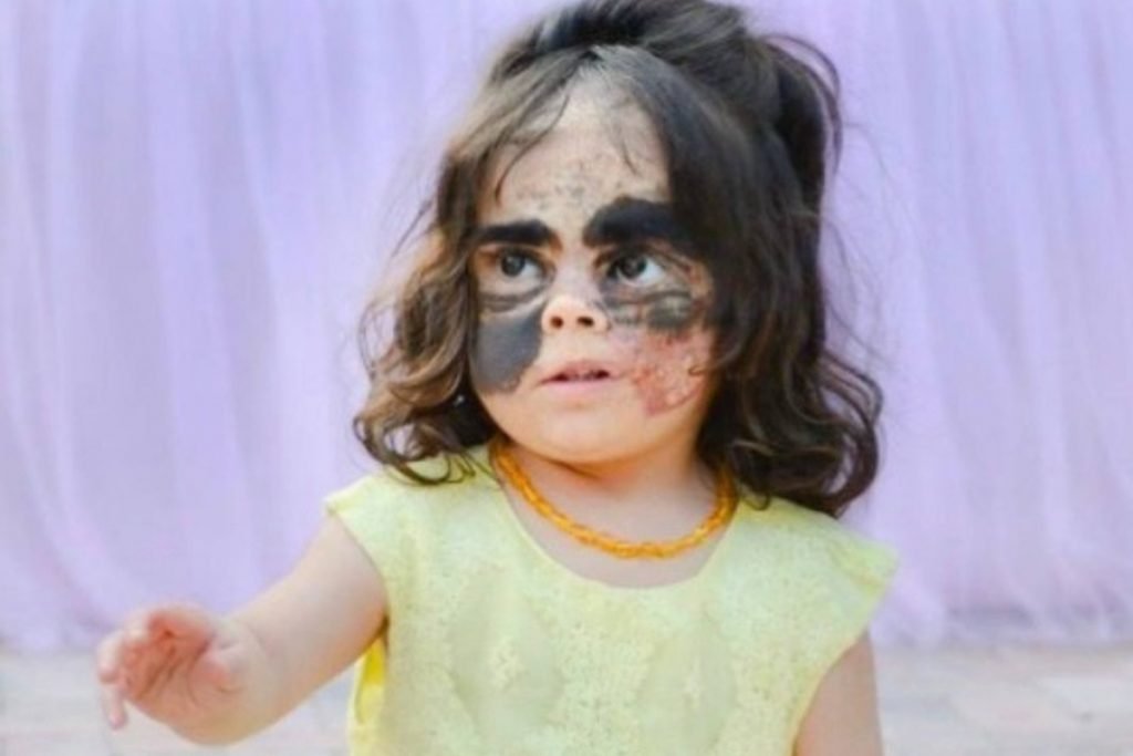 Menina que nasceu com “máscara do Batman” já passou por 5 cirurgias ...