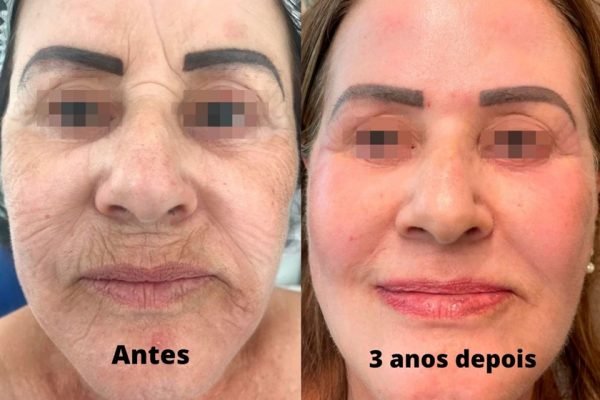 Peeling de fenol: vale a pena o sofrimento? Experts explicam a técnica ...