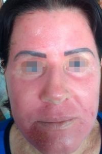Peeling de fenol: vale a pena o sofrimento? Experts explicam a técnica ...