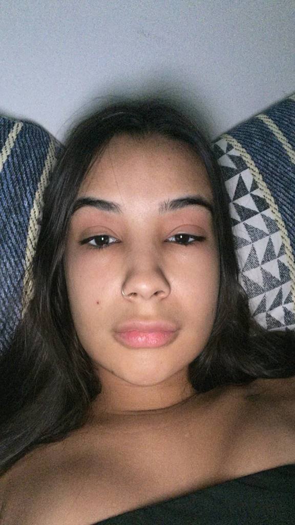 Estudante tem reação alérgica bizarra ao reverter preenchimento labial ... Estudante tem reação alérgica bizarra ao reverter preenchimento labial ...