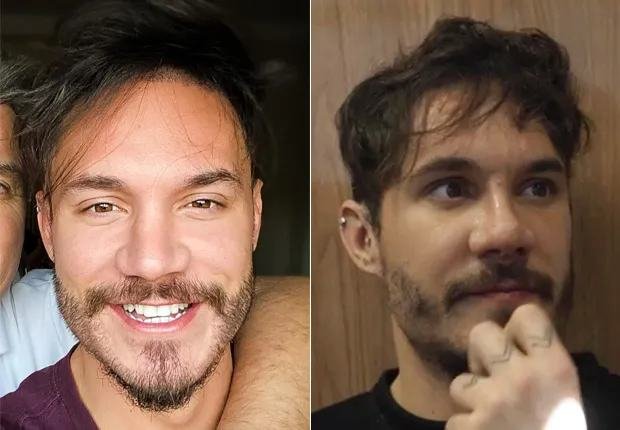 Eliezer exibe nariz após realizar rinoplastia. Veja antes e depois ...