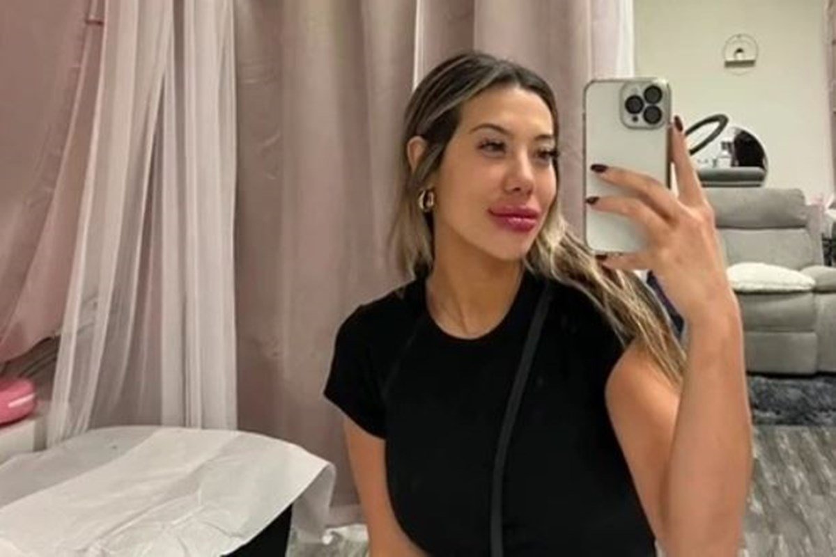 Mulher tem reação alérgica a preenchimento e resultado é assustador ...