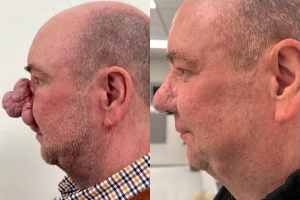 “Me sentia o homem elefante”, diz britânico após reconstrução do nariz ...