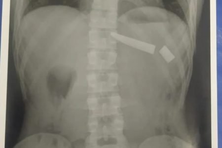 Faca quebra dentro do tórax de homem durante briga com vizinho em GO ...