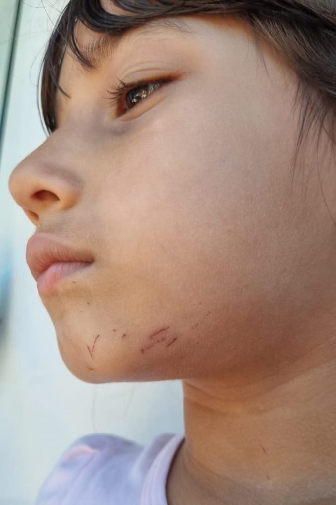 Dermatite atópica: mãe conta desafios de filha com a doença crônica ...