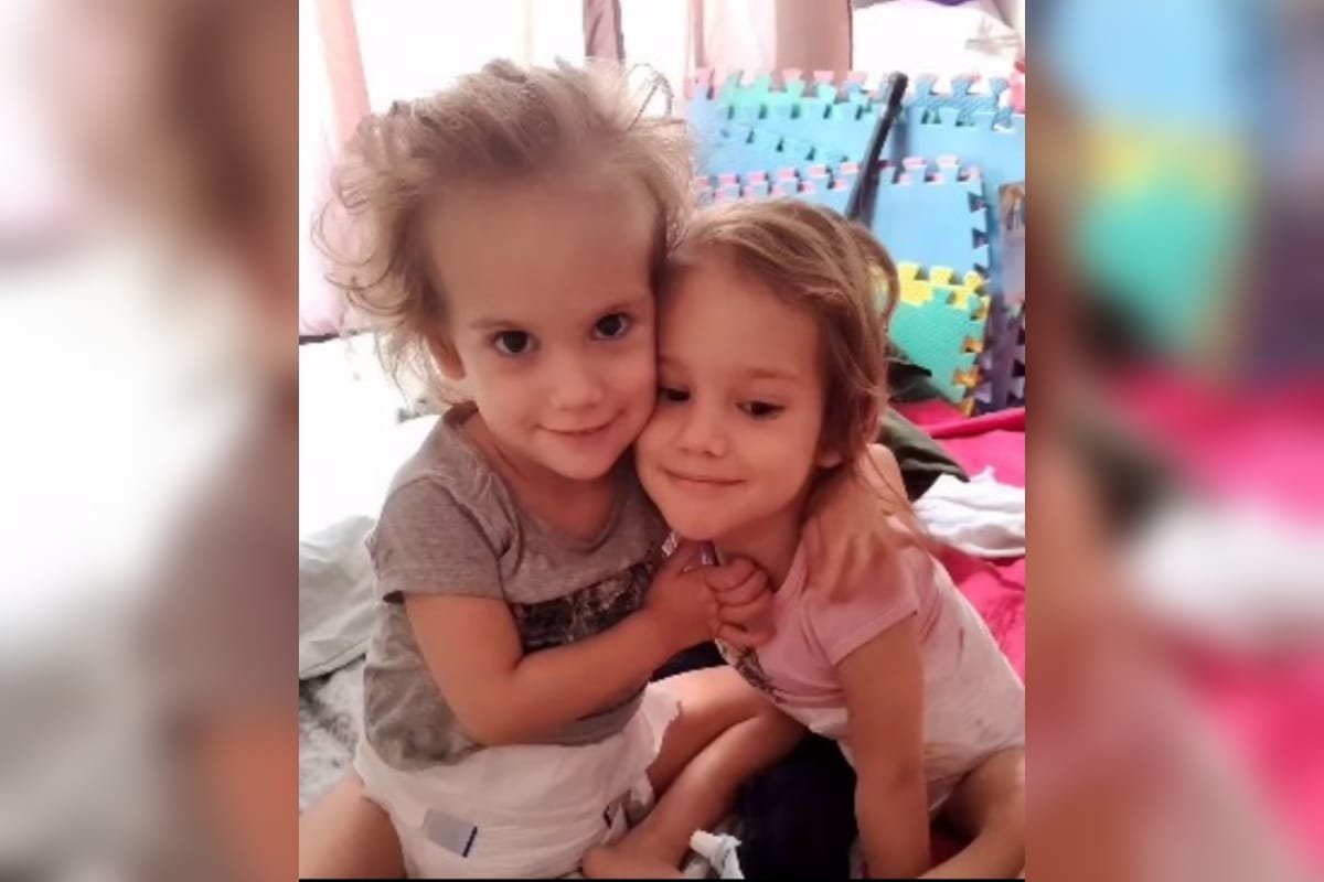 Recuperação surpreendente: veja como estão as gêmeas siamesas separadas ...