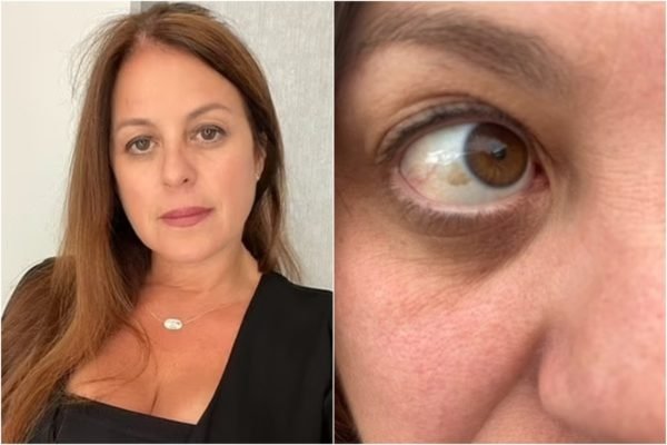 Mulher fica parcialmente cega após sofrer queimadura de sol nos olhos | Metrópoles