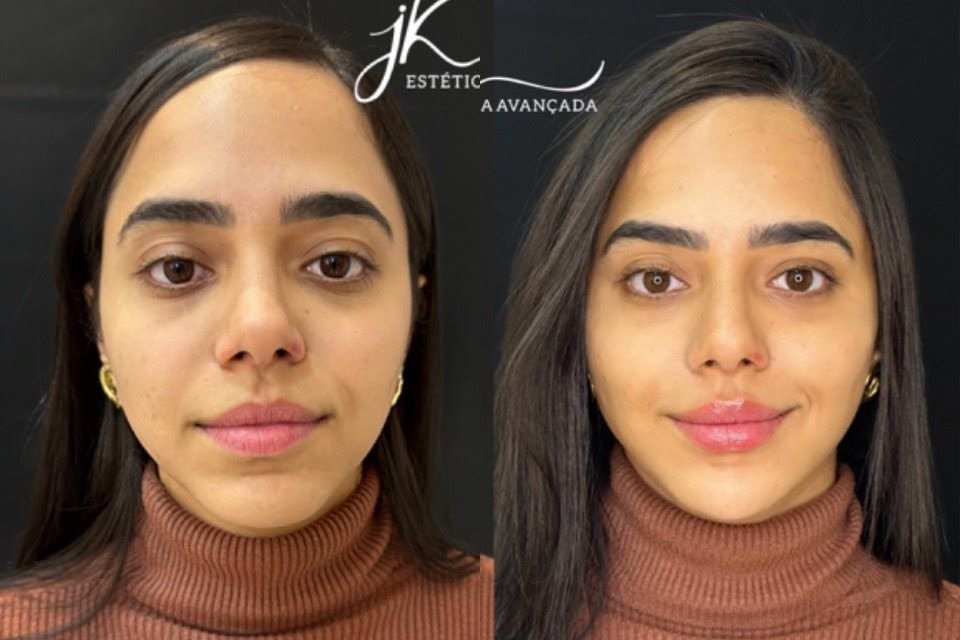 Botox, harmonização… Veja detalhes dos procedimentos que Marielly fez ...