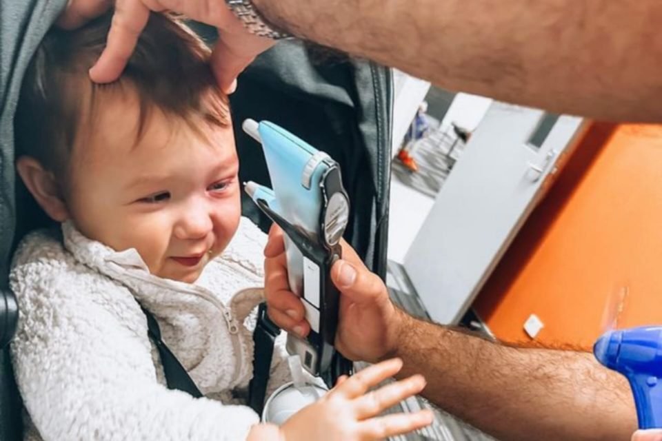 Tratamento a laser remove marca de pele de bebê de 5 meses. Entenda ...