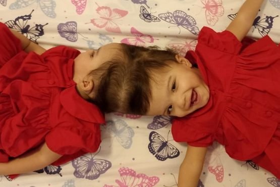 Gêmeas siamesas recebem alta um mês após cirurgia de separação | Metrópoles