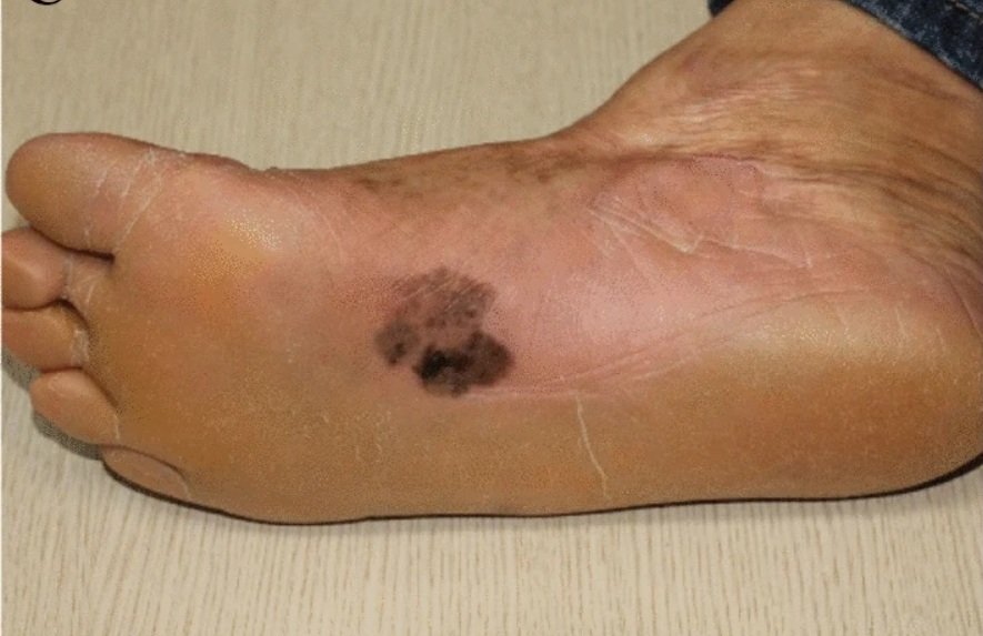 Melanoma acral: câncer de pele grave é mais comum no Norte do país ...