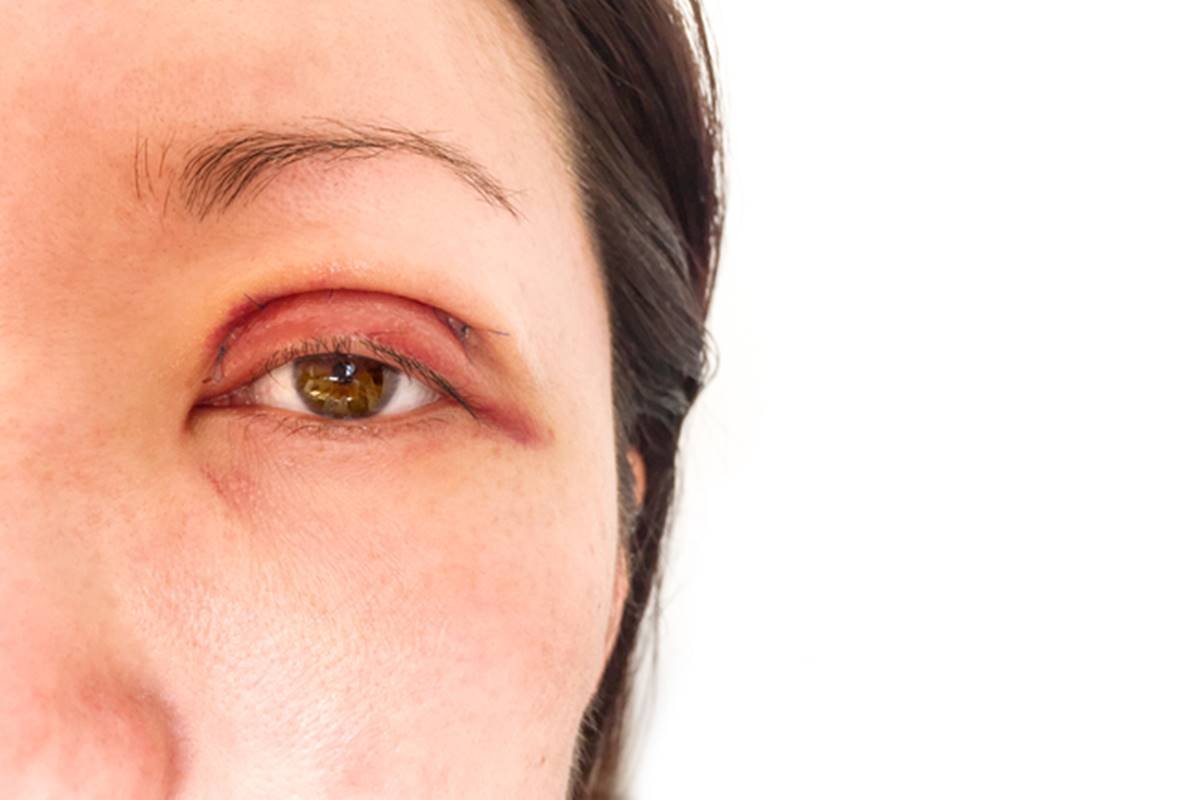 Herpes ocular: o que é, quais são os sintomas, qual o tratamento | Metrópoles