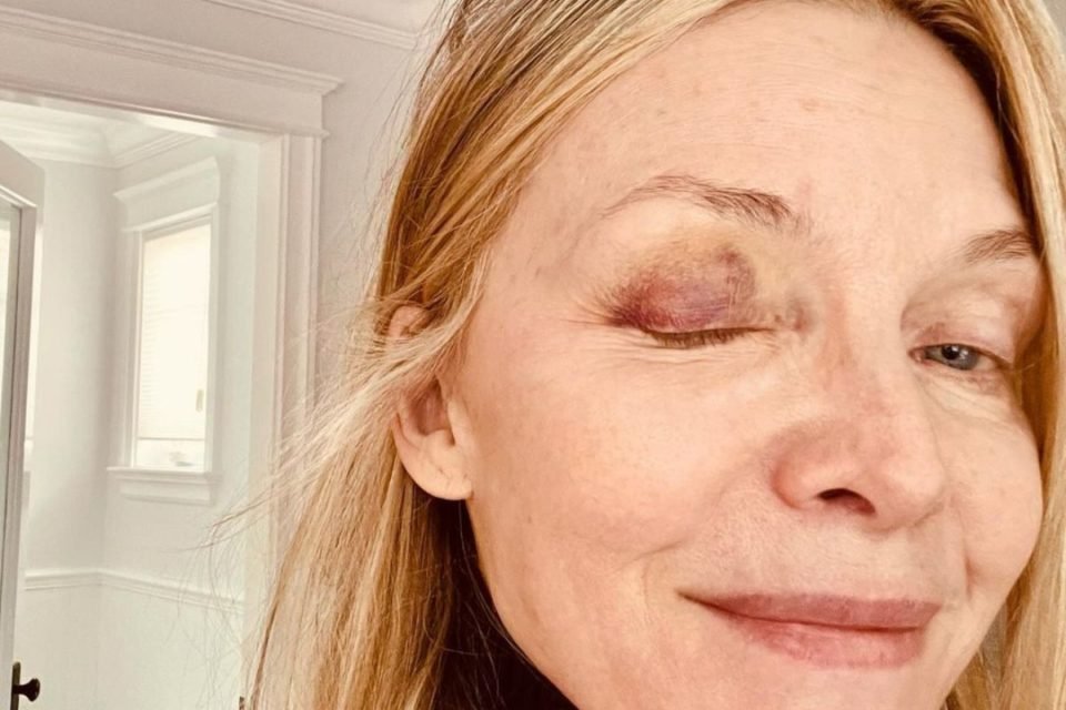 Michelle Pfeiffer aparece com saco de gelo em olho roxo e assusta web ...