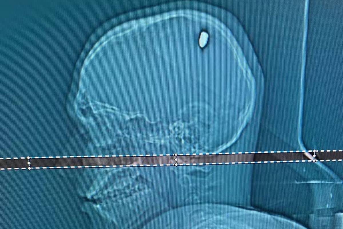 Jovem é atingido por bala perdida na cabeça e só percebe 4 dias depois ...