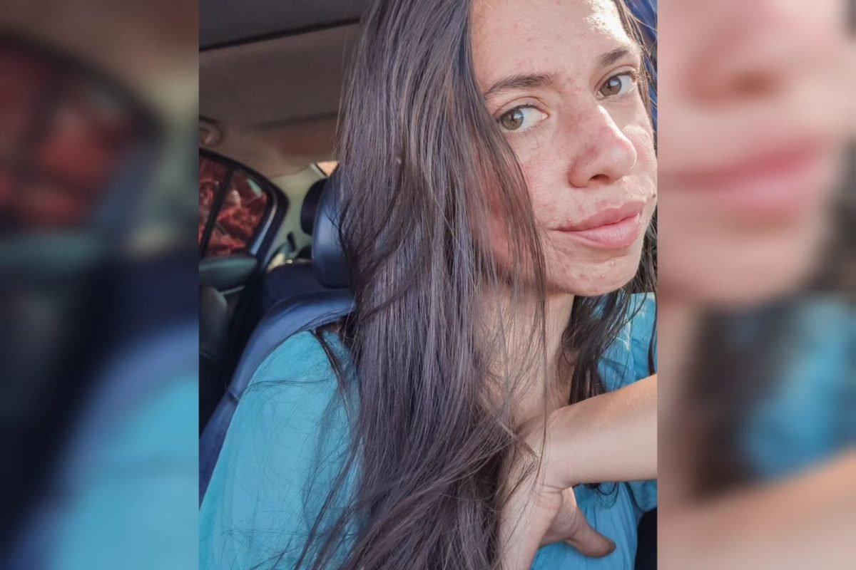 “Vivia com dor”, conta influenciadora que tem acne severa há 14 anos ...